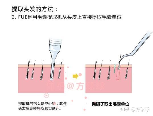 植发技术最成熟可靠的是？FUE、FUE、微针 优缺点分析 - 知乎