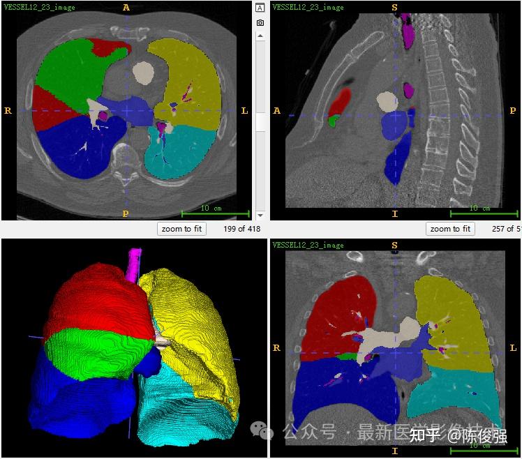 VESSEL2012——肺血管分割 - 知乎