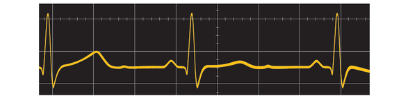 如何生成复杂的心电图(ECG)波形? - 知乎