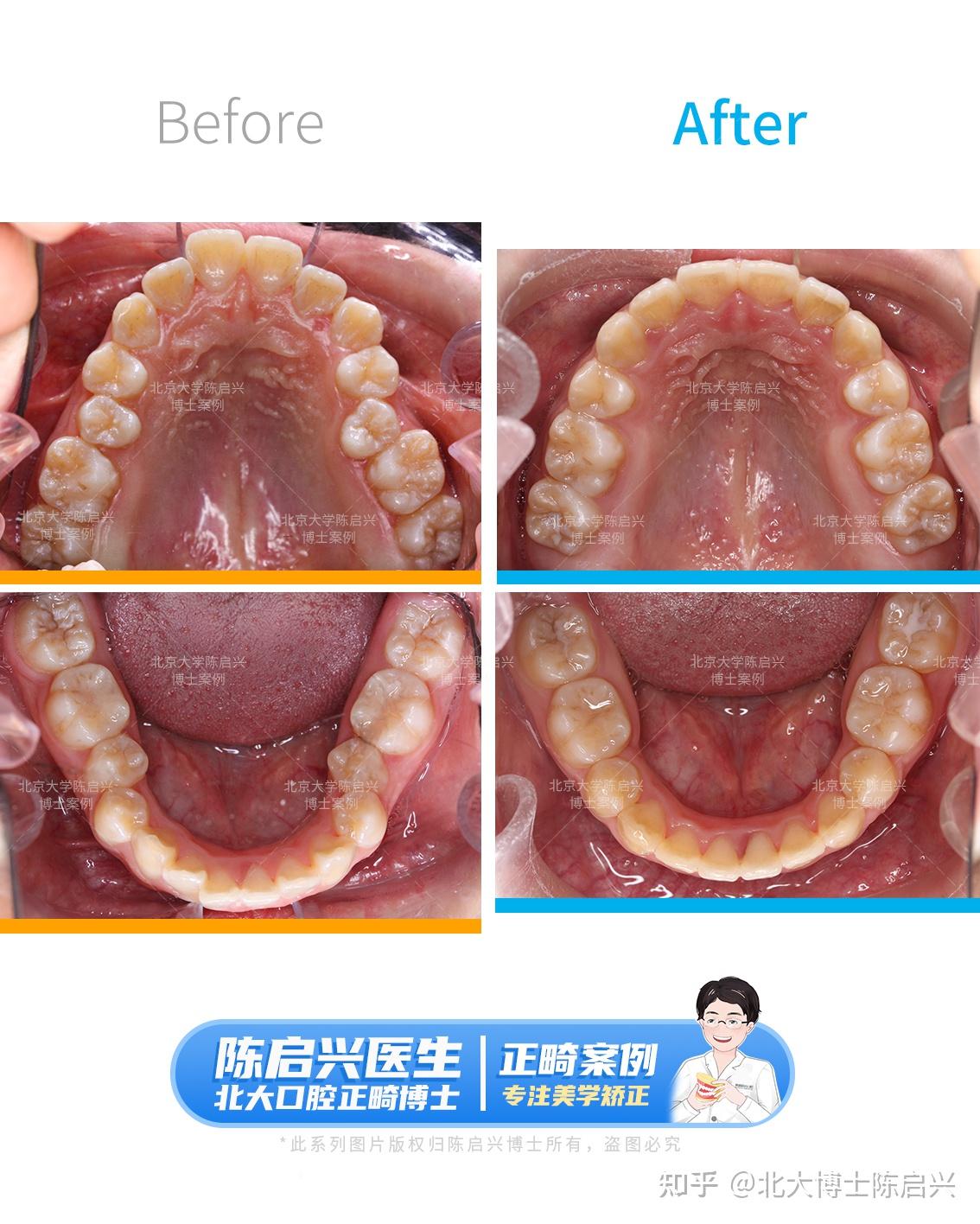 青少年案例 | 解除牙齿拥挤，咬合更健康 - 知乎