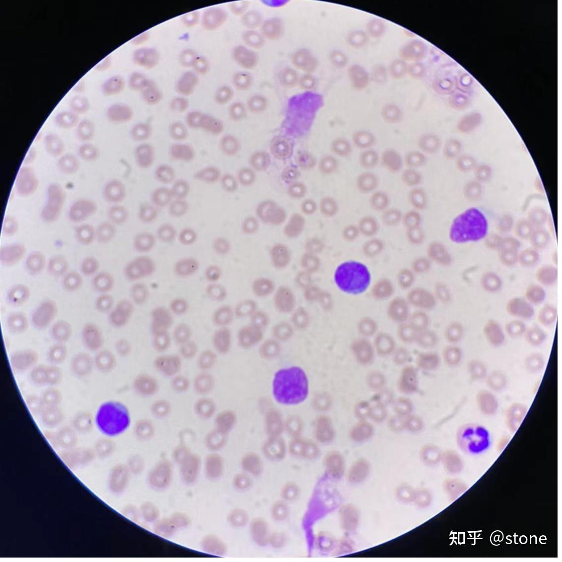 13-2022112721320009084650-W54-AML-M2 - 知乎