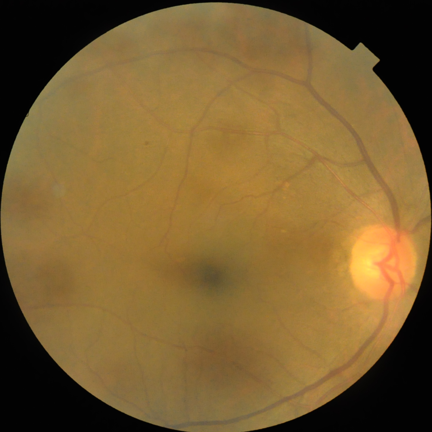 Multi-Label Retinal Diseases视网膜眼底图像分类数据集介绍 - 知乎
