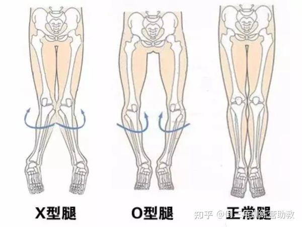 『O型腿矫正』【线上教学】 - 知乎