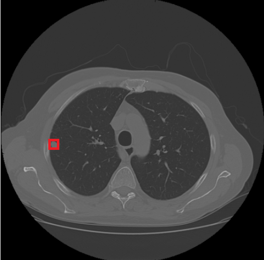 LUNA16 肺结节检测数据集介绍 - 知乎
