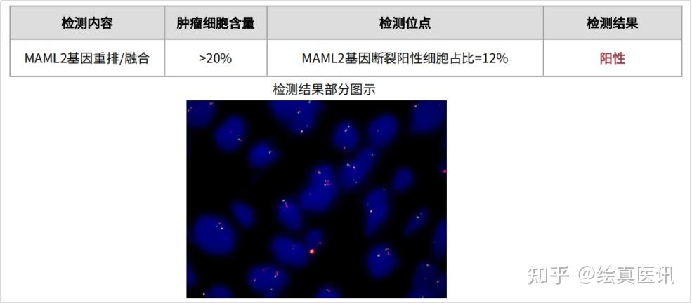 “绘”解读真报告丨通过MAML2基因融合检测案例，了解黏液表皮样癌 - 知乎