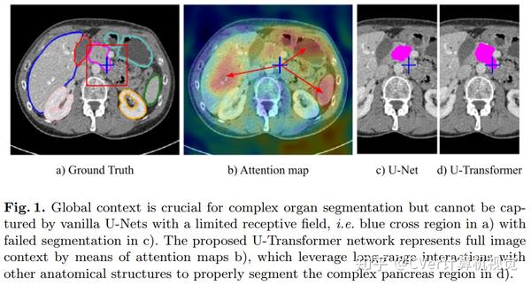 U-Net Transformer：用于医学图像分割的自注意力和交叉注意力 - 知乎