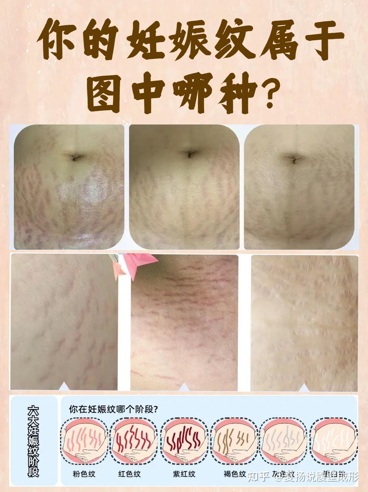 产后妊娠纹、肥胖纹、生长纹怎么办?不要慌!你可以这样拯救 知乎