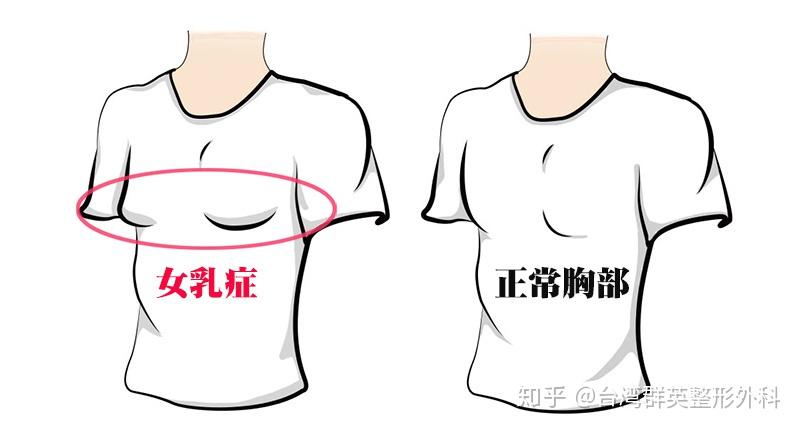 两张图教你判断露胸膛与露乳的差别自己分辨男性女乳症状|苏毓彬医师|台湾群英整形 知乎