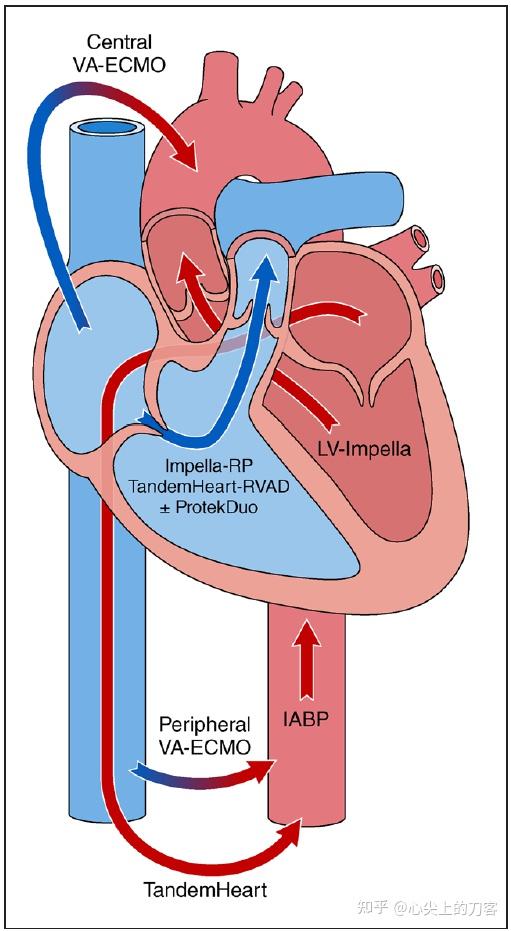 学术速递丨一文看懂Impella、IABP、VA-ECMO和TandemHeart——美国心脏学会科学声明 - 知乎