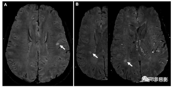磁敏感加权成像（SWI)：技术要点和临床神经学应用 - 知乎