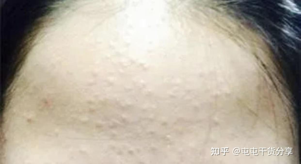 痘痘妹子必备 知乎