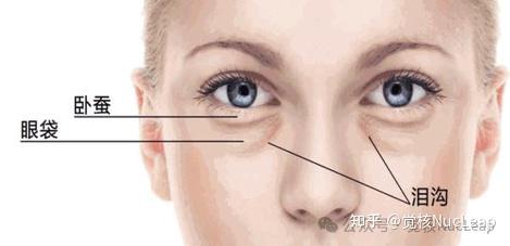 泪沟填充全面解析：从解剖层次、注射技法到风险规避，一篇讲透 - 知乎