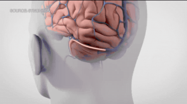 关于脑机接口，只知道Neuralink公司还不够 - 知乎