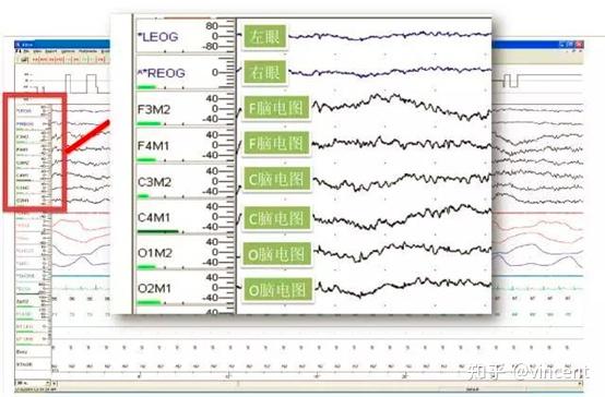 多导联睡眠呼吸监测PSG解读 - 知乎