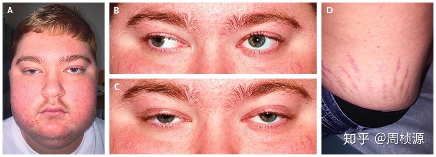 nejm 2018 case 39 - 知乎