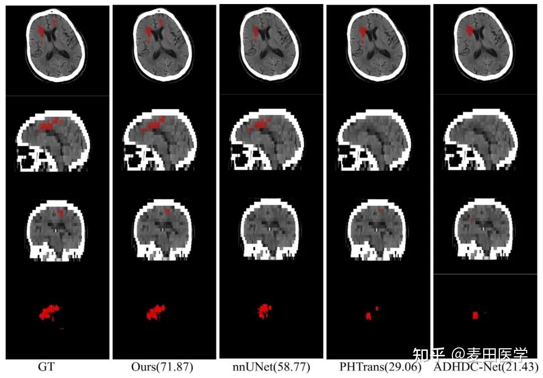 LW-CTrans：一种用于三维医学图像分割的轻量级CNN与Transformer混合网络|文献速递-深度学习医疗AI最新文献 - 知乎
