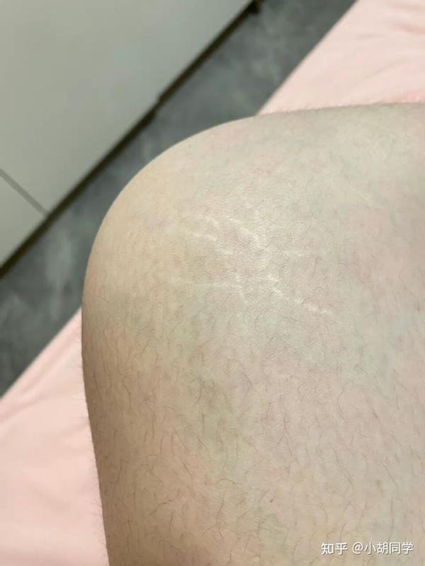 左滑和肥胖纹和解!! 知乎