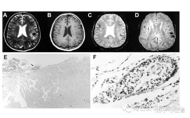 中枢神经系统血管炎是怎么样的呢 - 知乎