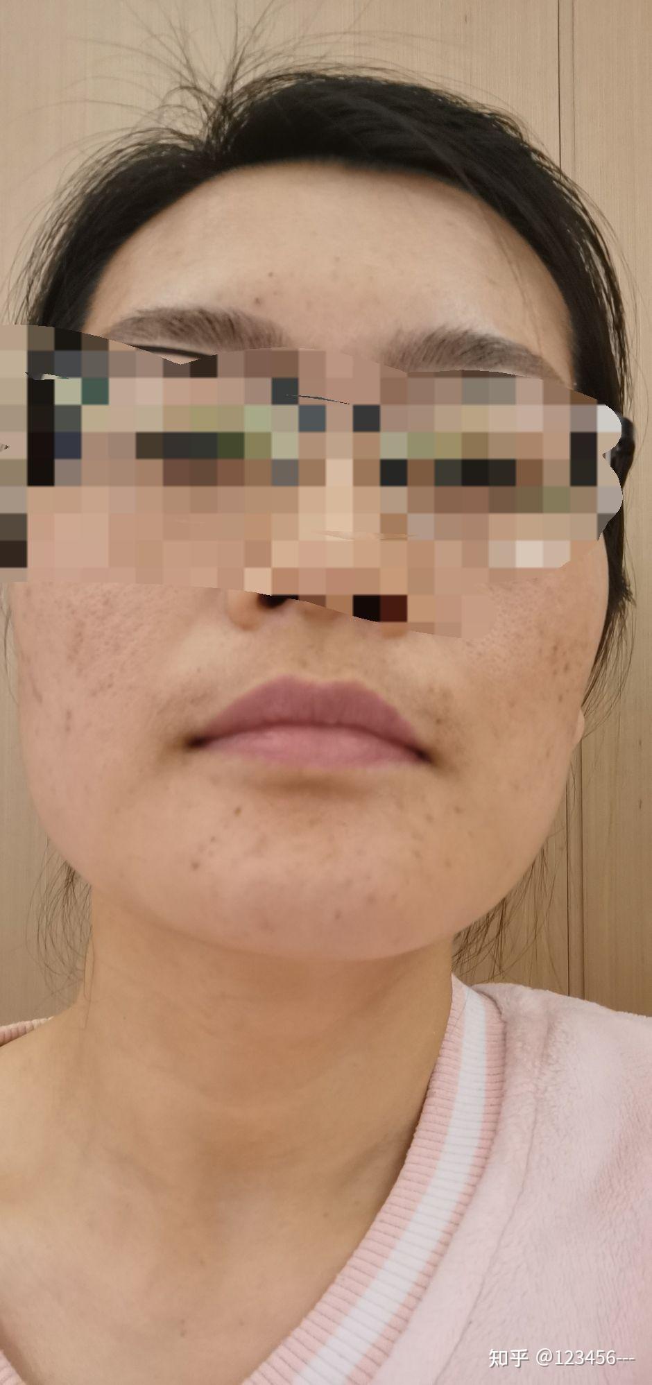 痘痘战痘士,胜利了 知乎