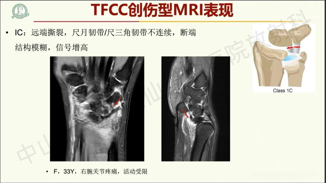 TFCC损伤MRI诊断 - 知乎
