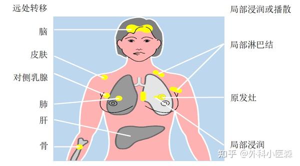 与汝同行之乳腺癌临床病理分期—TNM - 知乎