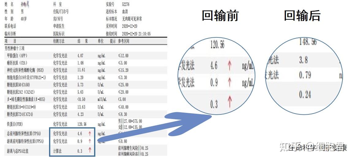 Tlr Dc T治疗前列腺瘤早期痊愈 知乎