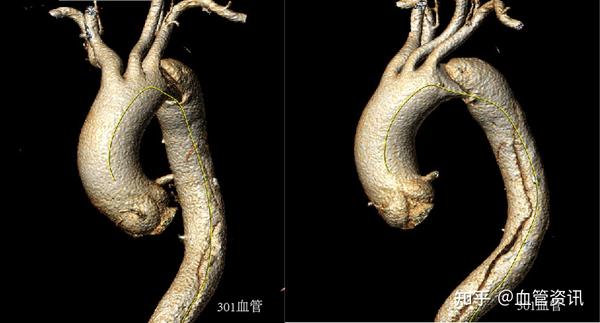 WeFlow-Tbranch单内嵌分支胸主动脉覆膜支架系统临床试验随访结果 - 知乎