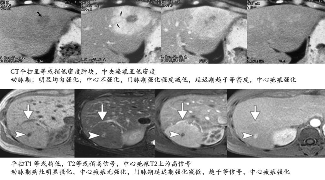 【高尚病例】FNH（肝局灶性结节增生） - 知乎