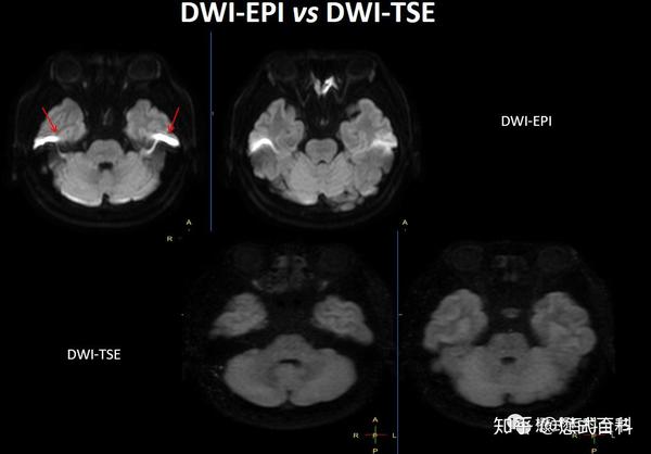 DWI-TSE无形变扩散成像 - 知乎