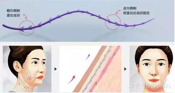 做完大v线提升忌口多久，做完大v线要注意事项很扎心 - 知乎