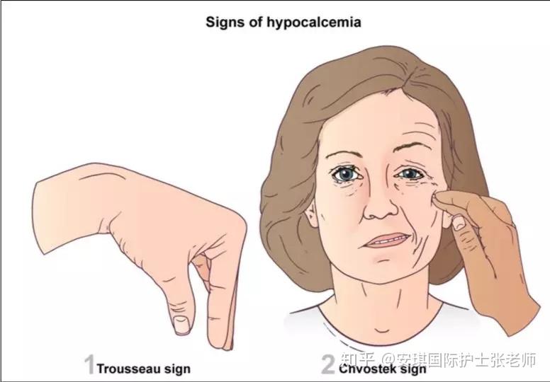 Chvostek's sign&Trousseau's sign, 这是什么体征？ - 知乎