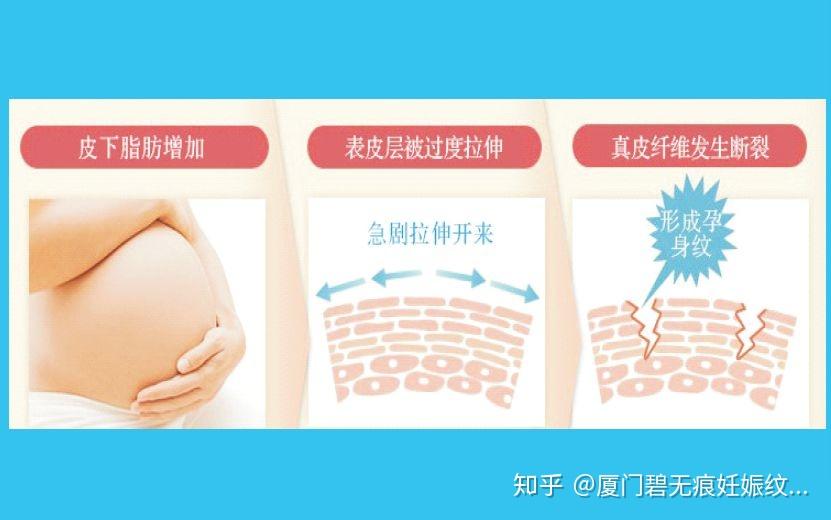别等了,妊娠纹不会自己消失! 知乎