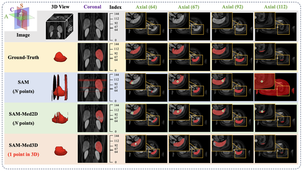 SAM-Med3D：三维医学图像上的通用分割模型，医疗版三维 SAM 开源了！ - 知乎