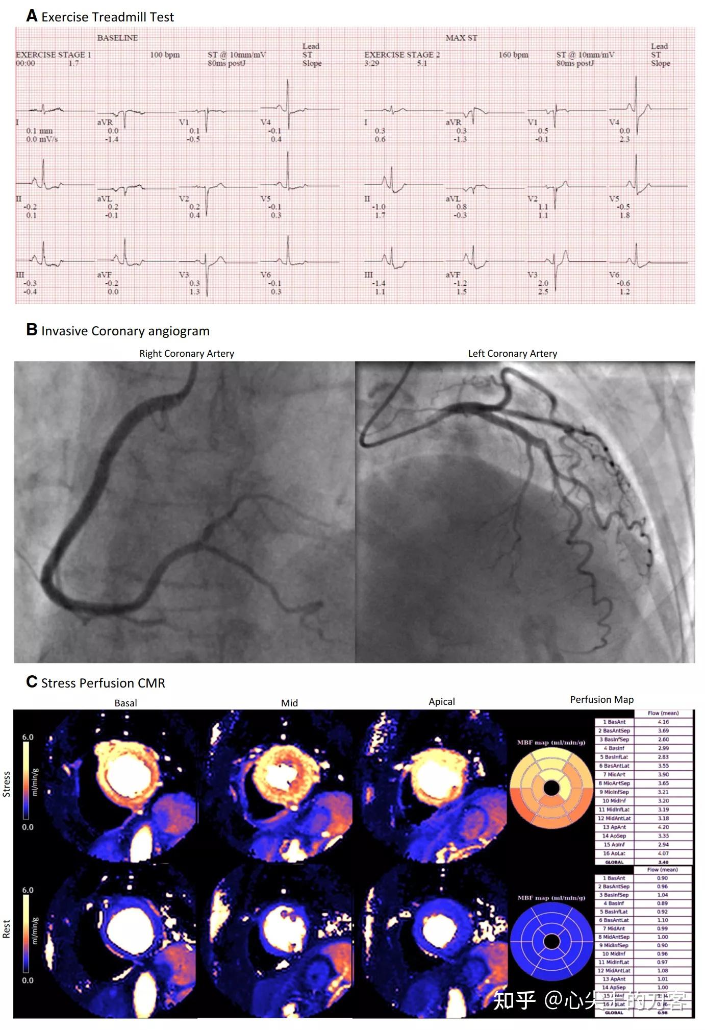 冠状动脉微血管疾病：定义、诊断和流行病学 - 知乎