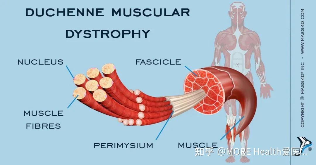 DMD世界知晓日，你知道什么是DMD吗？ - 知乎