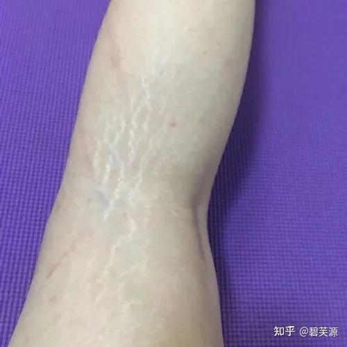 让肥胖纹消失，只减肥没有用 知乎