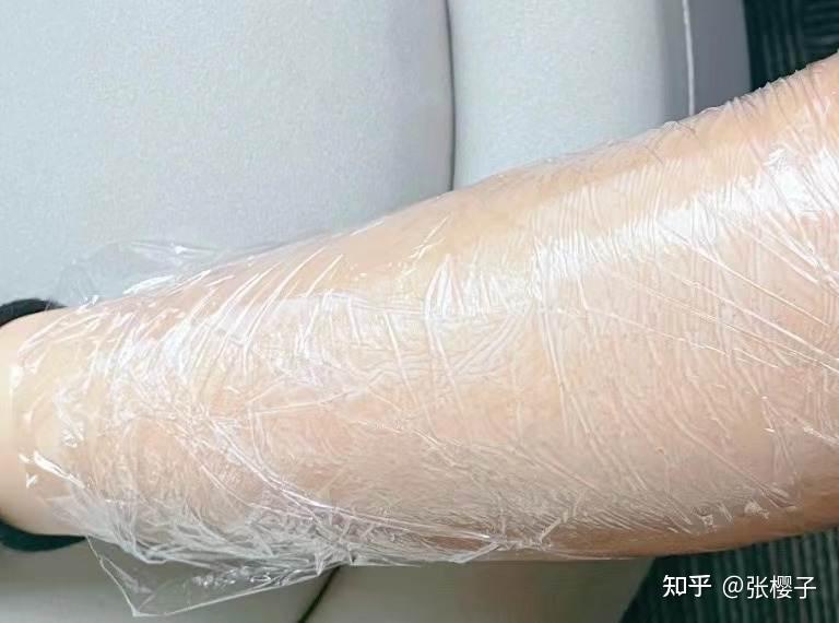 长胖了还长了肥胖纹怎么办？肥胖纹能救吗？”万年 难搞肥胖纹到底应该怎么淡化？内有最全肥胖纹淡化方法和步骤！