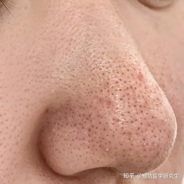 专业医生保姆级去黑头方法!千万别用暴力方式去黑头了,安全去黑头仅需4步,一个月养成牛奶鼻!拒交智商税! 知乎