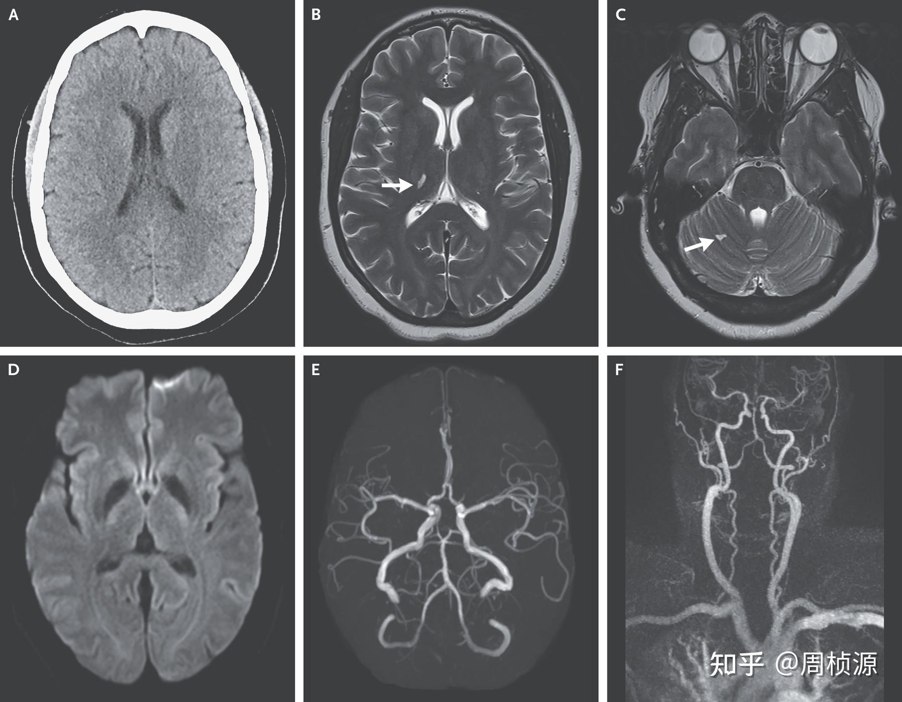 Nejm 2022 Case 12 - 知乎