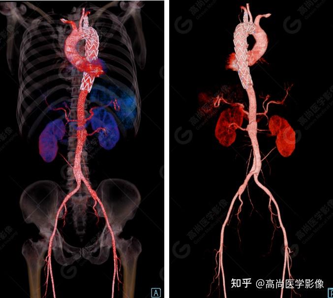 什么是CTA检查？哪些人需要做这个检查？ - 知乎