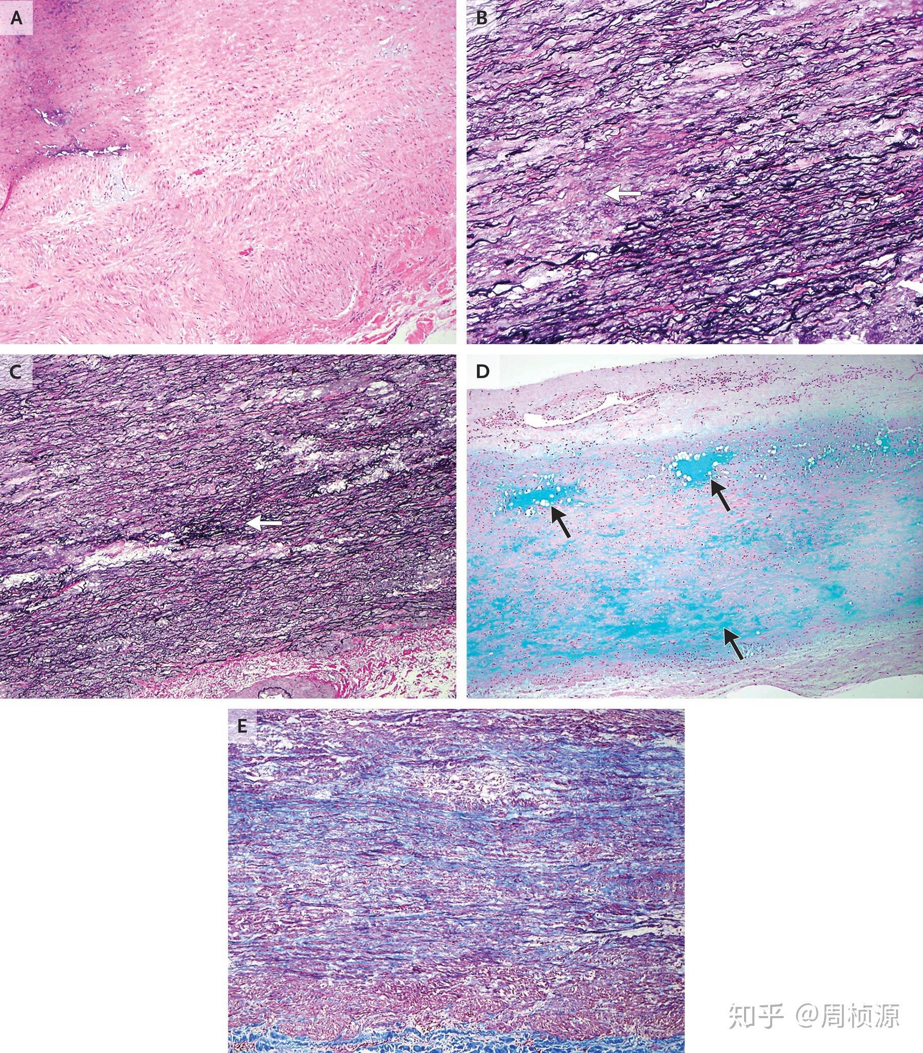 Nejm 2018 case 38 - 知乎