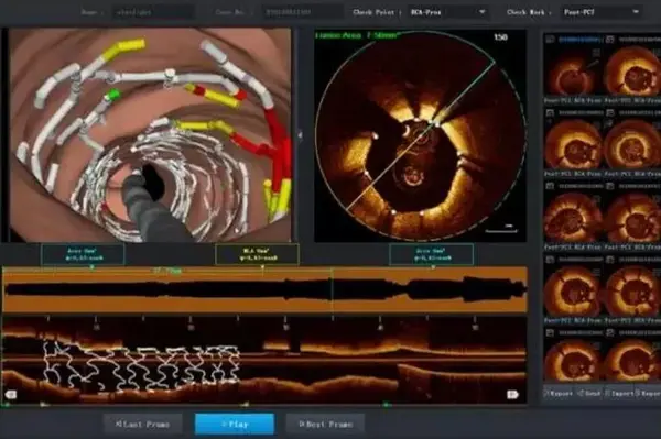 医疗器械技术解析- 什么是OCT - 知乎