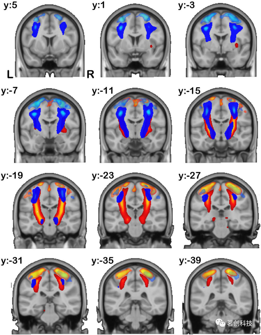 Hum Brain Mapp | 联合连接矩阵独立成分分析：结构和功能连接的自动链接 - 知乎