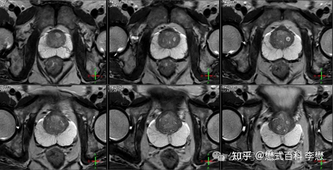前列腺磁共振中mp-MRI、bp-MRI和abp-MRI - 知乎