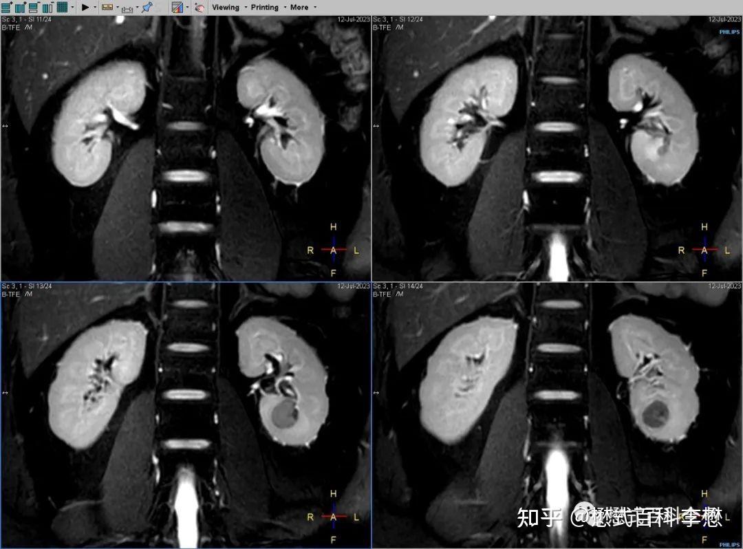 肾脏囊性病变的Bosniak分级 - 知乎