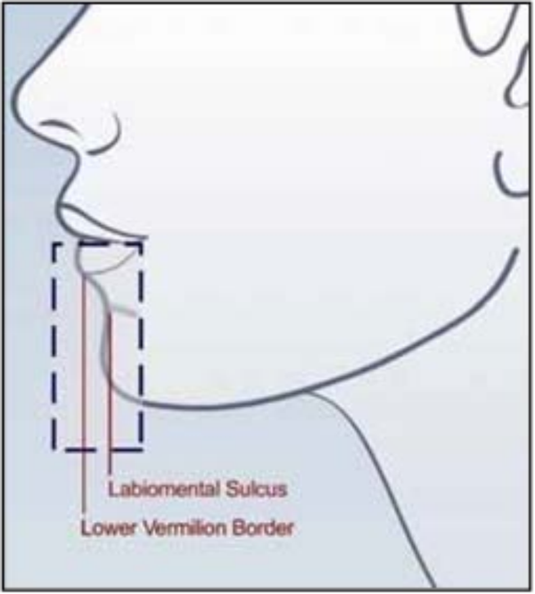 美国艾尔建公司JUVÉDERM® VOLUMA™ XC用于下巴填充的产品介绍 - 知乎