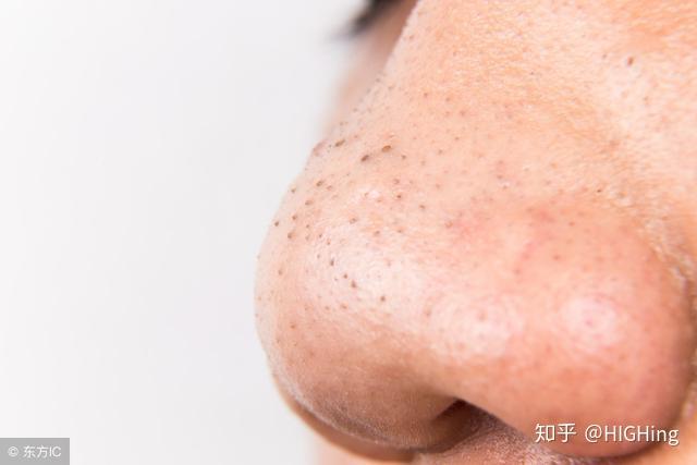 鼻子的黑头怎么天然的去掉?这些方法简单不花钱 知乎