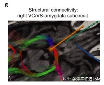 【THERAPY】Closed-loop neuromodulation in an individual with treatment-resistant depression - 知乎