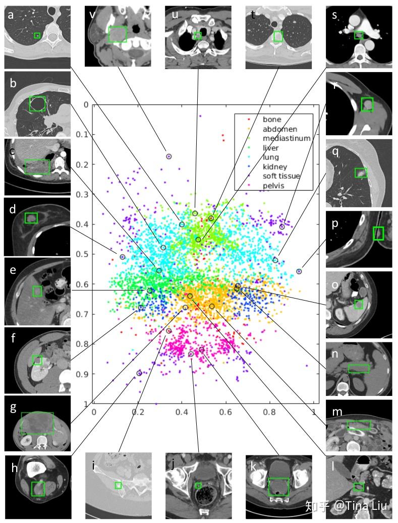 肺部肿瘤检测数据集汇总（新更 2/20/20） - 知乎
