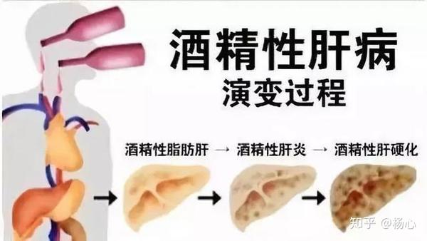 酒精性肝病演变过程 知乎